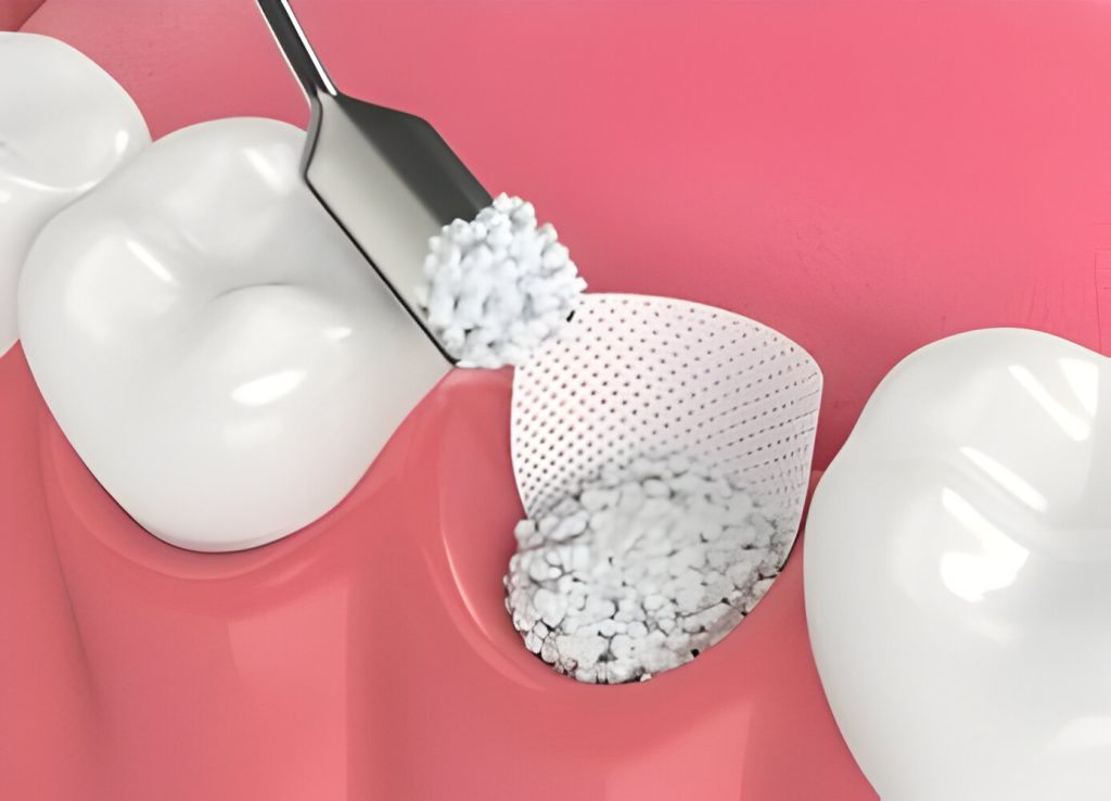 Bone Grafting 101: What You Need to Know?