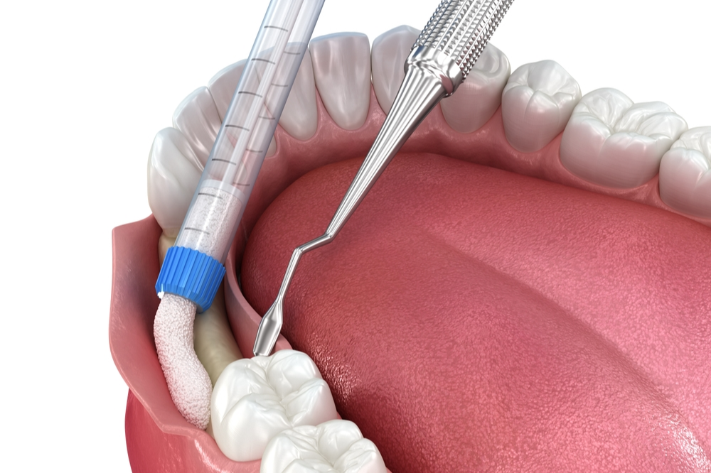 Understanding Dental Bone & Gum Grafts: A Guide for Patients